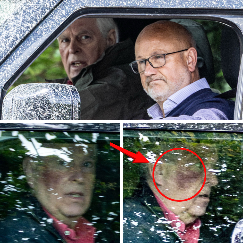 WHAT HAPPENED TO PRINCE ANDREW? The Truth Behind the Large Purple ...